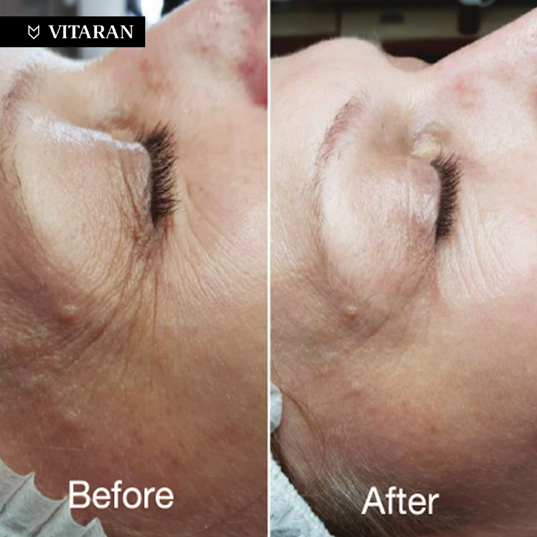 Polynucleotide Skin Injectables - Cheshire Skin & Laser Clinic